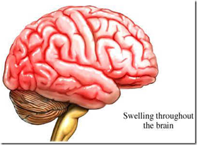 ENCEPHALITIS | studynursing